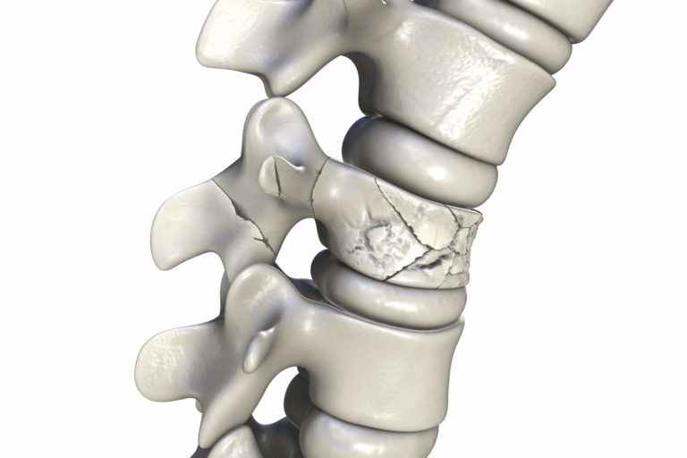 Spinal Compression Fracture Guide | Centurion Spine & Pain Centers